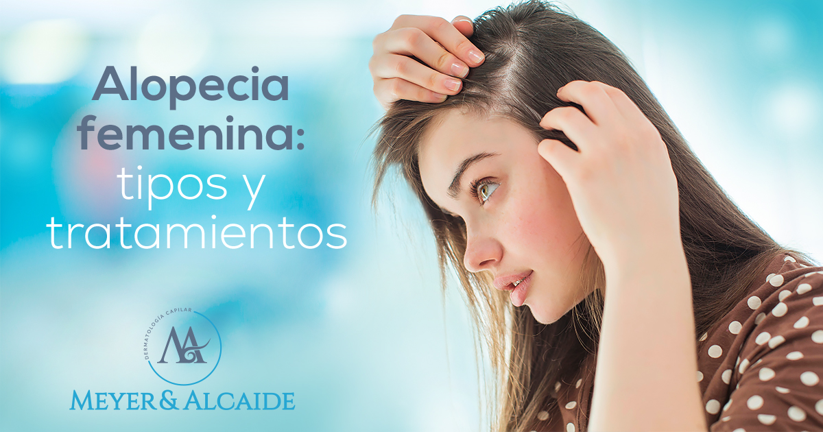 Alopecia femenina: tipos y tratamientos - Meyer & Alcaide